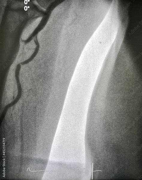 Image result for Angiogram Radial