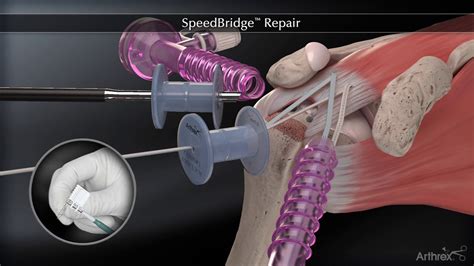 Image result for SpeedBridge Methods
