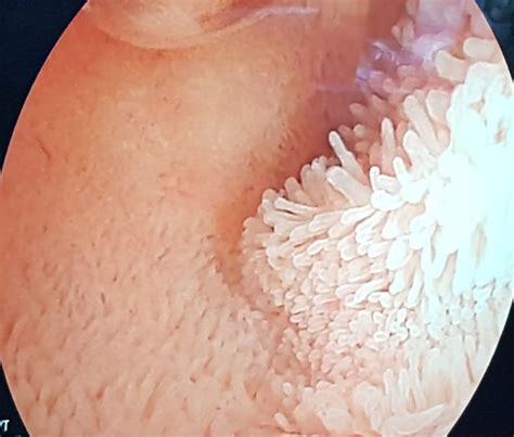 Image result for Endoscopy Small Intestine