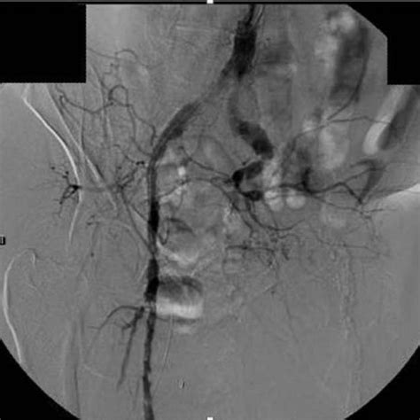 Image result for Left Lower Extremity Angiogram
