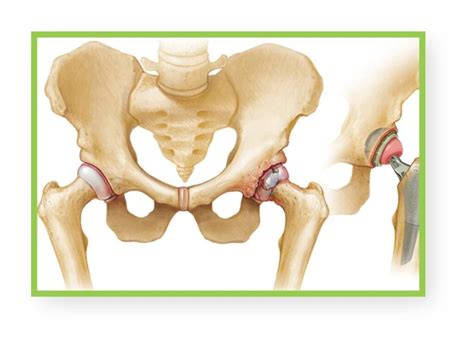 Image result for Hip-Replacement Post Operative Care