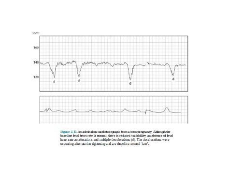 Image result for CTG and Partogram