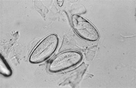 Image result for What Is Pinworm