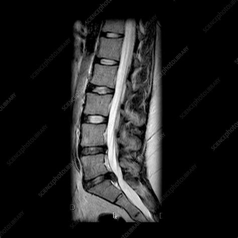 Image result for How to View MRI Disc