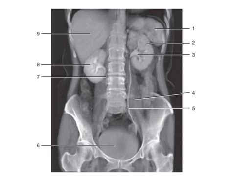 Image result for CT Urogram Topogram Fix