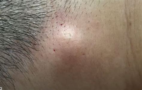 Image result for Big Exploding Cyst Neck