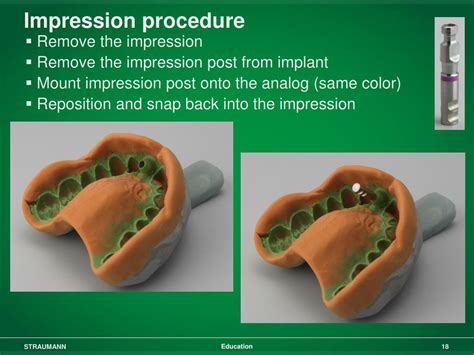 Image result for Impression Procedure
