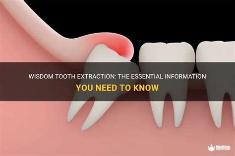 Image result for Wisdom tooth Extraction
