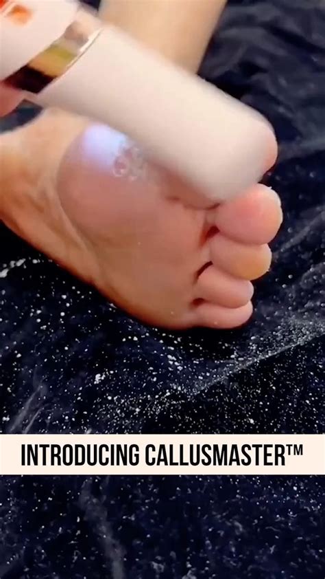 Image result for How to Remove Calluses Forever