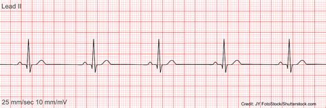 Image result for ECG Reading Practice