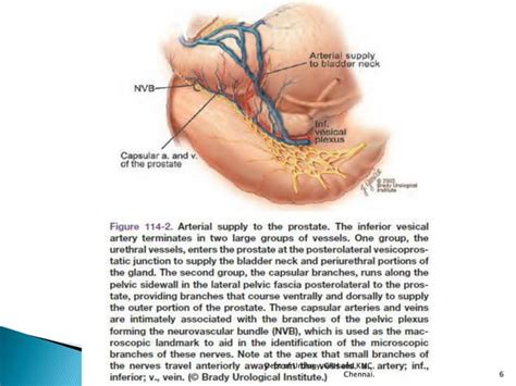 Image result for Open Radical Prostatectomy Surgery