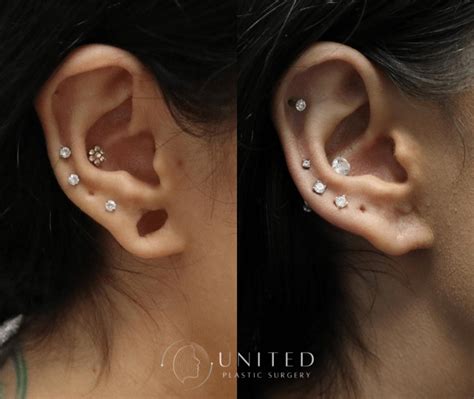 Image result for Reconstructive Surgery Procedure