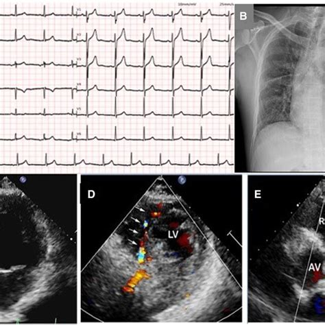 Image result for Normal EcG
