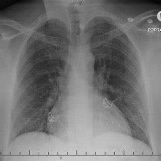 Image result for LINQ Loop Recorder