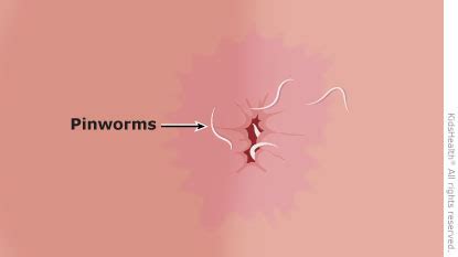 Image result for Pinworm Skin