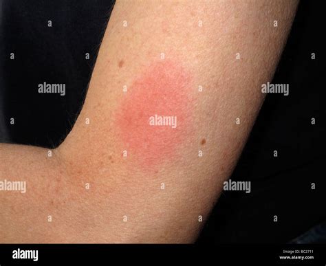 Image result for Shingles On Arm