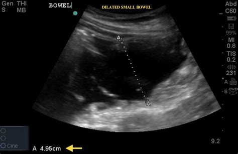 Image result for Intussusception