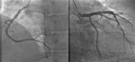 Image result for Normal Coronary Angiogram