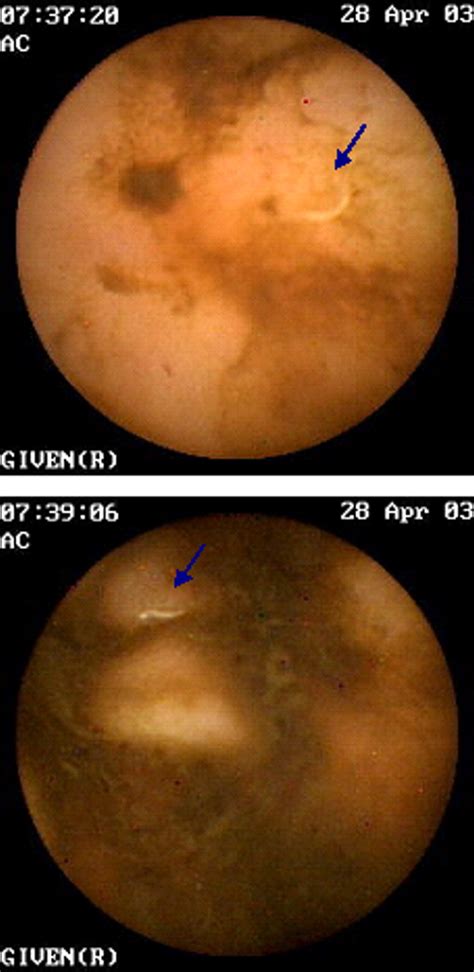 Image result for Pinworm Tape Test Procedure