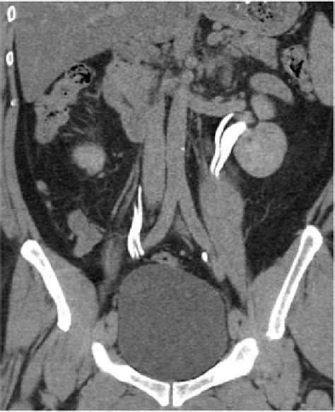 Image result for Urogram 3 Phase CT