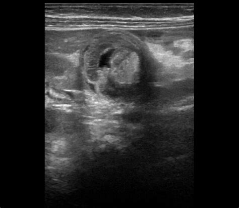Image result for Intussusception Pseudokidney Sign
