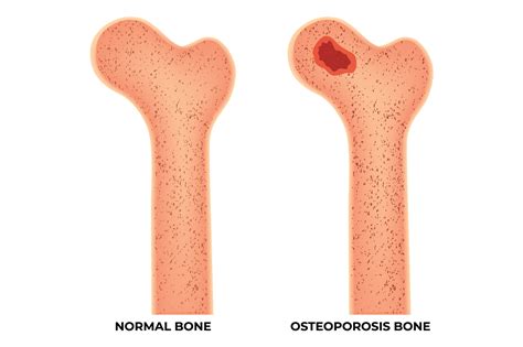 Image result for Normal Bone Formation