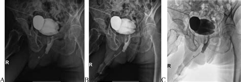Image result for Urethrogram Procedure