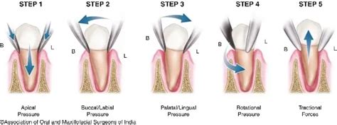 Image result for Tooth Extraction Forcep PHY