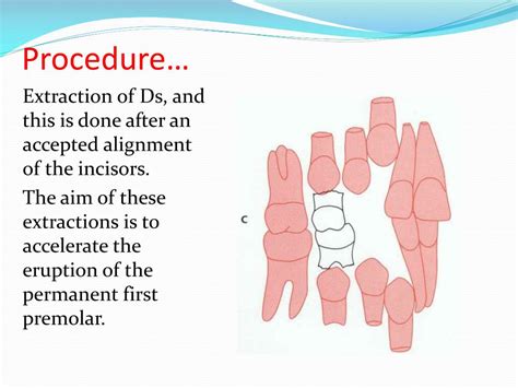 Image result for Serial Extraction Process
