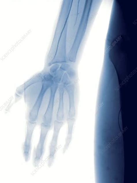 Image result for Hand Angiogram