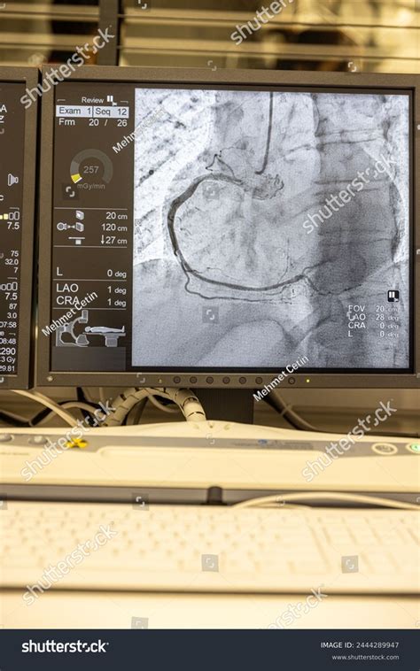 Image result for Angiogram Radial