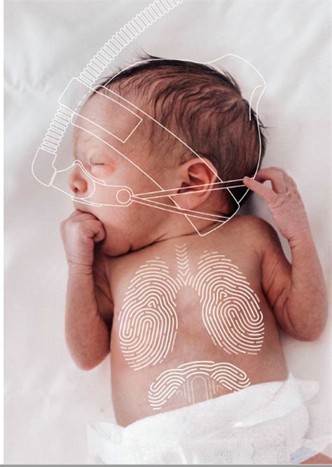 Image result for Non-Invasive Intubation