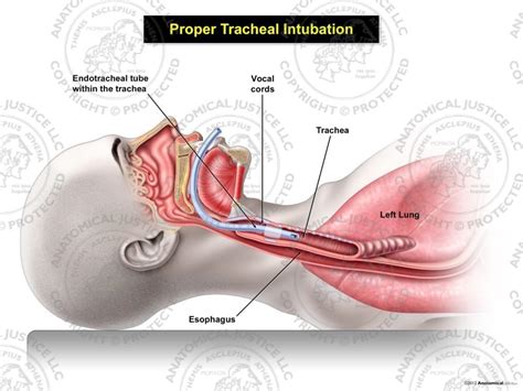 Image result for How to Do Intubation