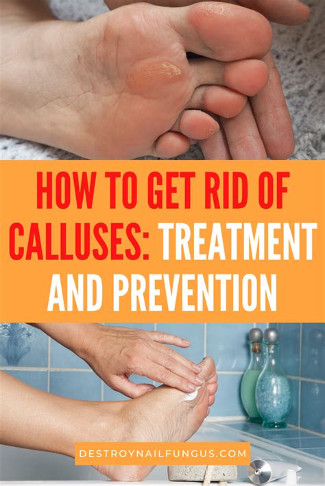 Image result for How to Remove Calluses Forever