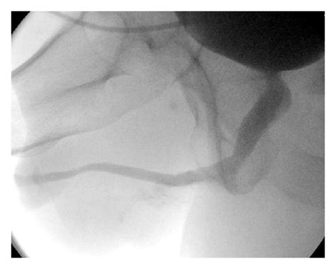 Image result for Voiding Cystourethrogram Image