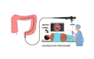 Image result for Normal Bowel Colonoscopy