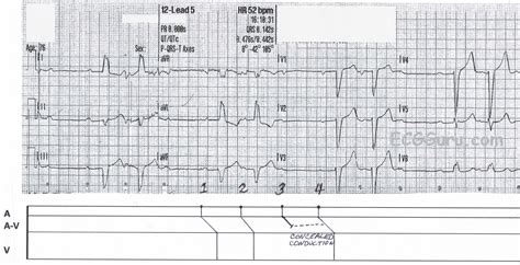 Image result for AV Block PR Interval