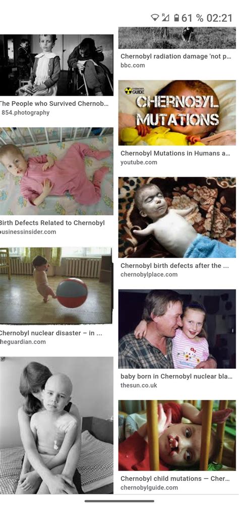 Image result for Birth Defects From Chernobyl Disaster