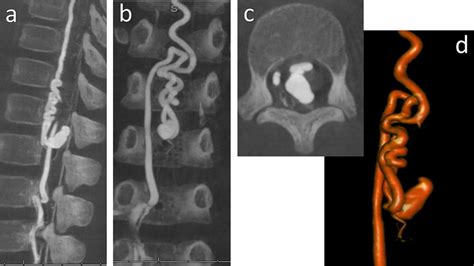 Image result for Spinal Angiogram