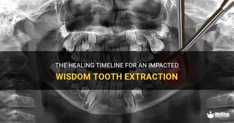 Image result for Impacted Wisdom Tooth Extraction