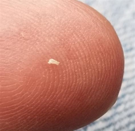 Image result for Splinter Finger