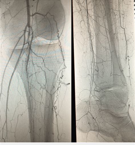 Image result for Left Lower Extremity Angiogram