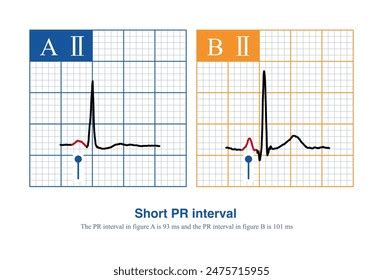 Image result for normal pr interval ecg