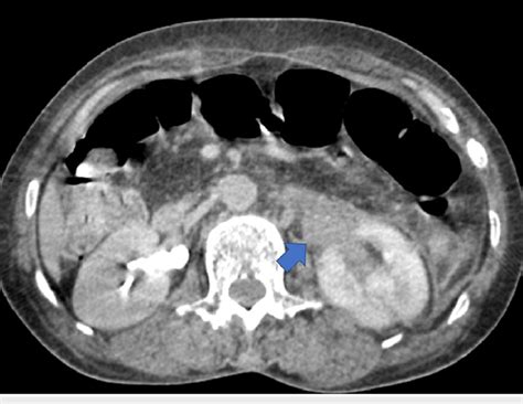Image result for Urogram CT Scan with Contrast Normal