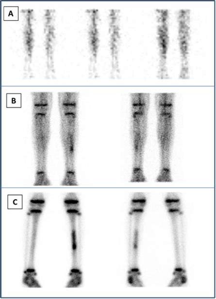 Image result for Triple Phase Bone Scan