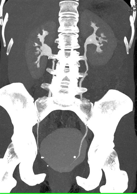Image result for Volume-Rendered CT Urogram