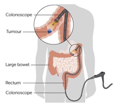 Image result for Normal Bowel Colonoscopy