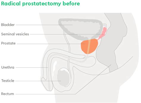 Image result for Simple vs Radical Prostatectomy