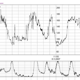 Image result for Variable Decelerations