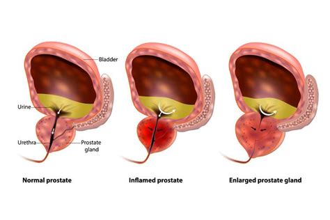 Image result for Simple vs Radical Prostatectomy